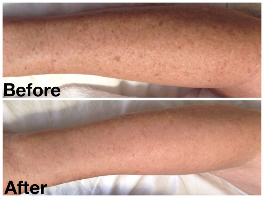 Sunspot & Freckle Removal - Denver Laser Solutions